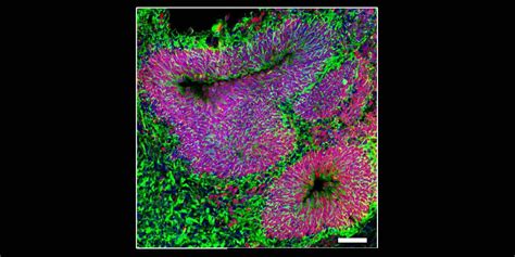 Lab Grown Mini Brains Reveal Insights Into Severe Autism And Potential