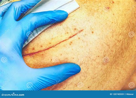 Pacemaker Scar Stock Image 25735675