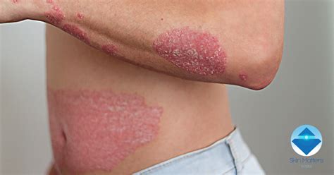 Plaque Psoriasis And Uvb Light Therapy A Proven Remedy For Skin Relief