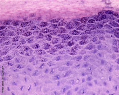 Plantar Wart Epidermis Hypergranulosis Hyperkeratosis Stock