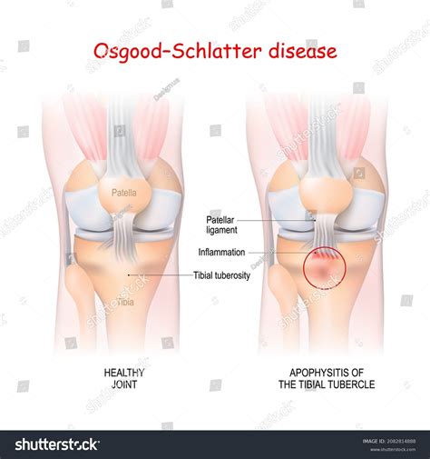 Disease Healthy Joint Apophysitis Tibial Tubercle Stock Vector Royalty Free 2082814888