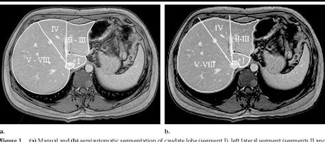 Liver Segments Ct