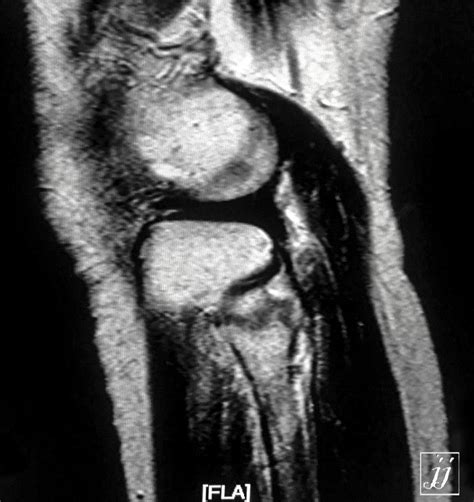 Msk Tibial Proximal Tumoral Fracture Radioogle