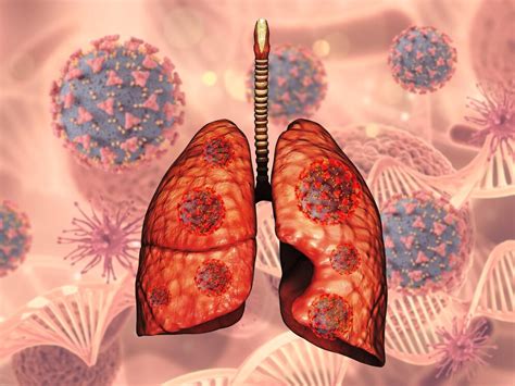 Insorgenza Di Mesotelioma Per Brevi Esposizioni Da Amianto