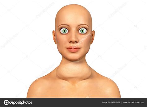 Hyperthyroidism Illustration Showing Female Graves Disease Also Known Toxic Diffuse — Stock