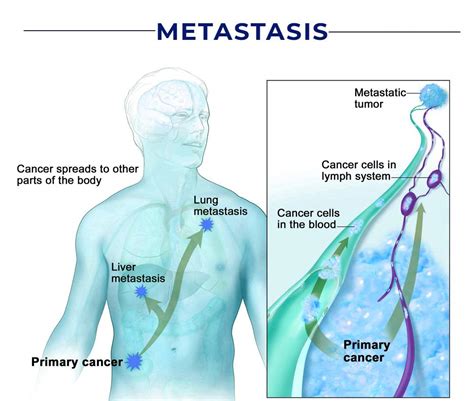 Cancer Treatment In Ludhiana Punjab Best Cancer Treatment Hospital