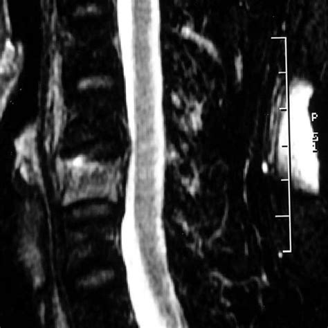 Sagittal Magnetic Resonance Imaging Of The Cervical Spine T2W2 Shows