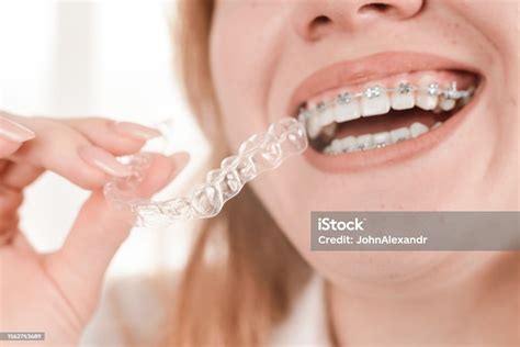 치과 치료 치아에 교정기를 착용한 웃는 소녀는 손에 교정장치를 들고 그 차이를 보여줍니다 건강관리와 의술에 대한 스톡 사진 및