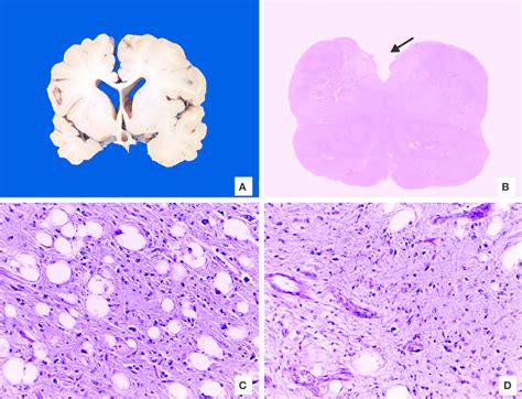 A Enlarged Lateral Ventricles With Data Of Cerebral Parenchyma Download Scientific Diagram