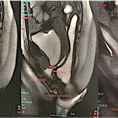 Pubococcygeal Line T2 Weighted Midsagittal Mr Image Of A Female Pelvis