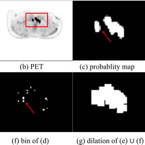 Visual Results Of The Node Selection Process A CT Image B PET Download Scientific Diagram