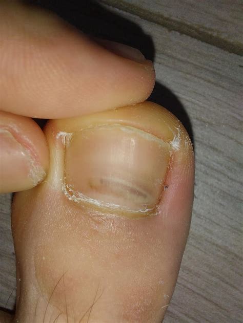 Any Idea About These Horizontal Brown Ridges On My Toenail Rdermatology