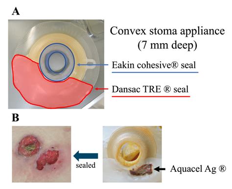 Diagnosis And Treatment Difficulty In Early Onset Peristomal Pyoderma