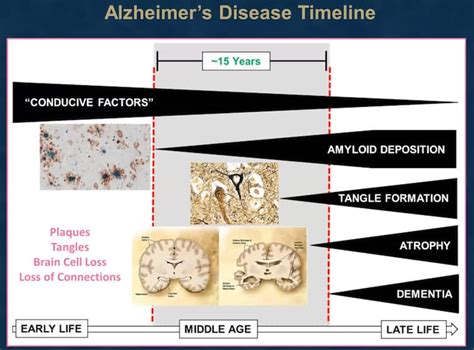 How To Improve Brain Health And Prevent Alzheimers Disease