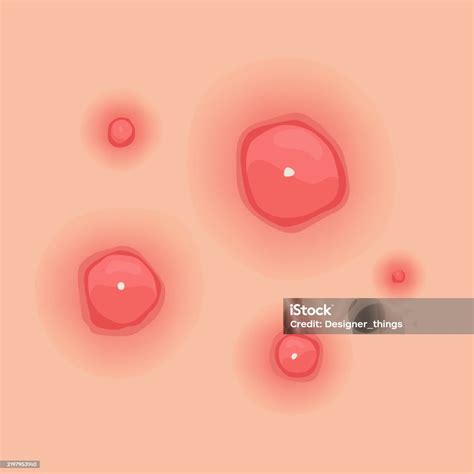 Understanding Type Of Acne A Comprehensive Visual Guide For Everyone Stock Illustration