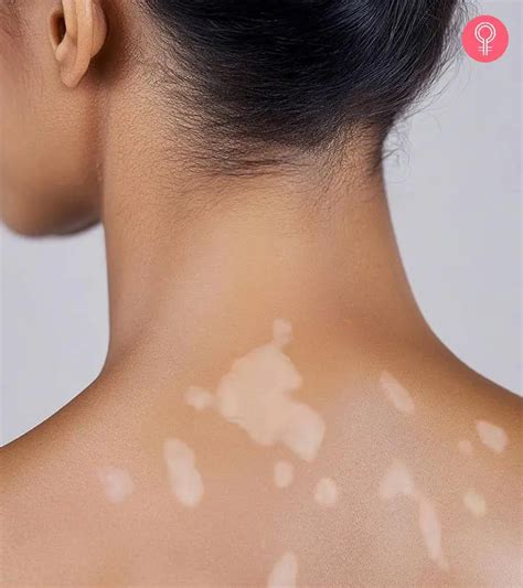 White Spots On Skin Pictures Causes Treatment Online How To Get Rid Of