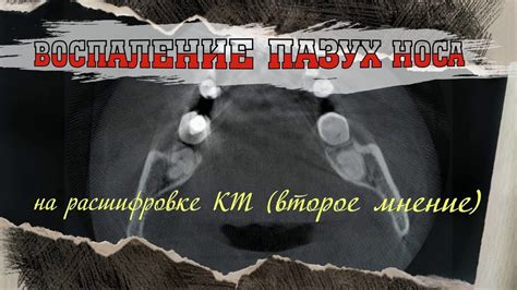 КИСТЫ гайморовых пазух и ВОСПАЛЕНИЕ лобной пазухи на РАСШИФРОВКЕ КТ пазух носа второе мнение