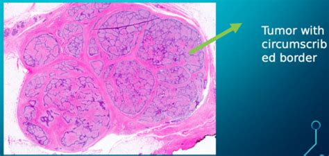 Neoplasia Flashcards Quizlet