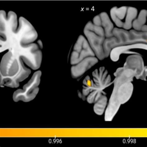 voxel based morphometry analyses showing regions of significant grey