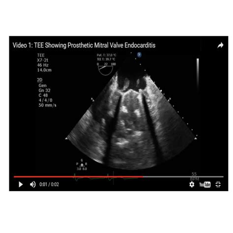 Pdf Prosthetic Mitral Valve Endocarditis Presenting As Complete Heart Block