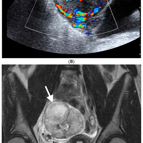 A Shows A Well Circumscribed Left Ovarian Mass Measuring 10 X 75 ×