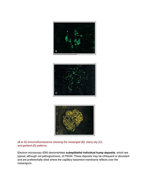 Post Streptococcal Glomerulonephritis Pdf