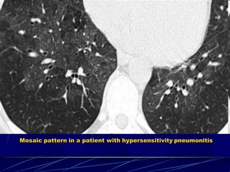 Reticular Pattern Ppt