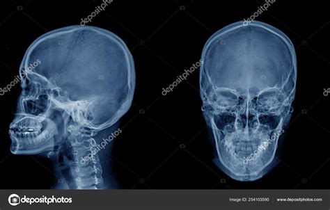 Xray Skull