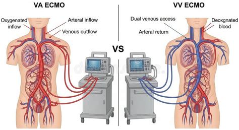 Vv Ecmo Stock Illustrations 5 Vv Ecmo Stock Illustrations Vectors And Clipart Dreamstime