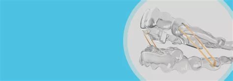 Ormco Launches Spark Retainers And Bitesync System