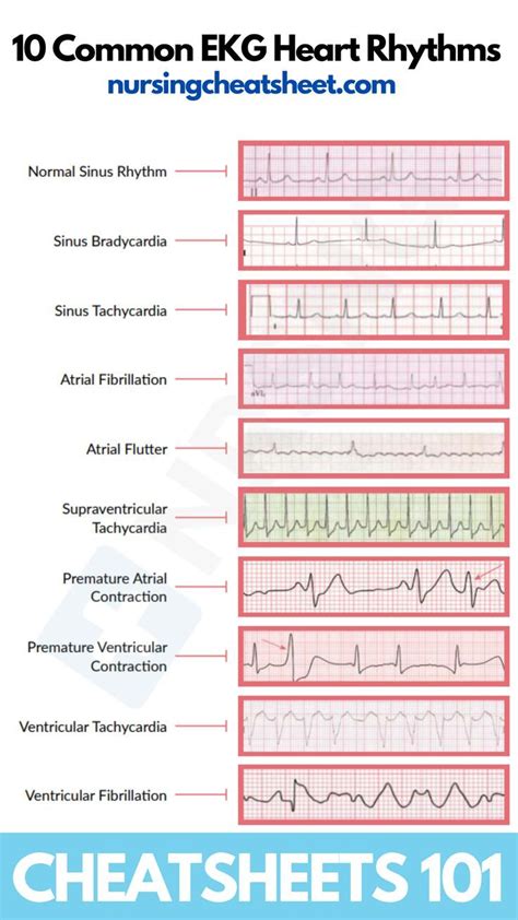 Types Of Ecg Rhythms