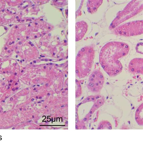 Pathological Features Of Renal Cell Carcinoma Rcc Tissues And