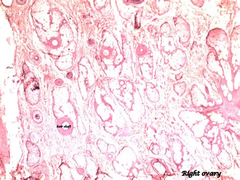 Bilateral Dermoid Ovarian Cyst In An Adolescent Girl Hakim And