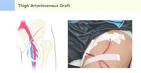 Schematic Representation Of A Thigh Arteriovenous Graft Reprinted