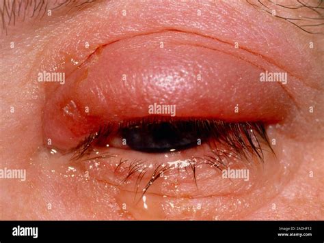 Conjunctivitis Close Up Of The Left Eye Of A Patient Suffering From