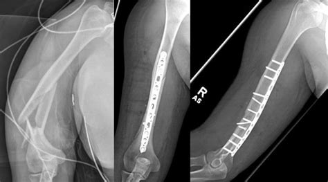 Complex Elbow Fractures East Bay Hand Medical Center Best Hand Surgeons
