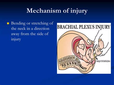 Erbs Palsy Ppt