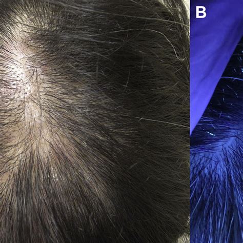 Patient 2 A There Was Diffuse Hair Loss And Scalp Erythema B The