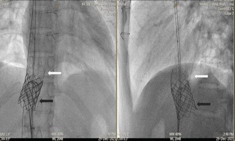Angiography Showing The Previously Embolized Covered Stent Successfully
