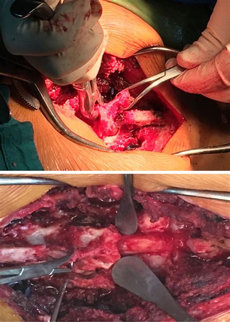 Superior Articular Process Of The T12 Vertebra The Spinous Process And