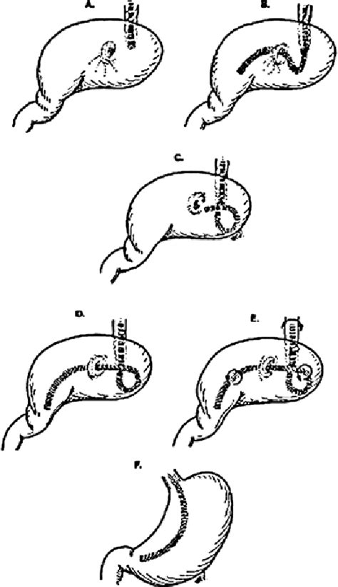 Figure 1 From Endoscopic Treatment Of Gastric Volvulus Semantic Scholar
