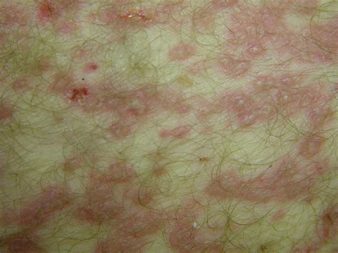 Disseminated Varicella Zoster Infection