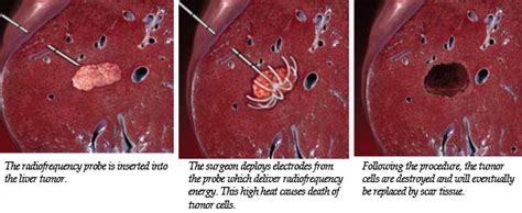 Radio Frequency Ablation For Liver Cancer Treatment
