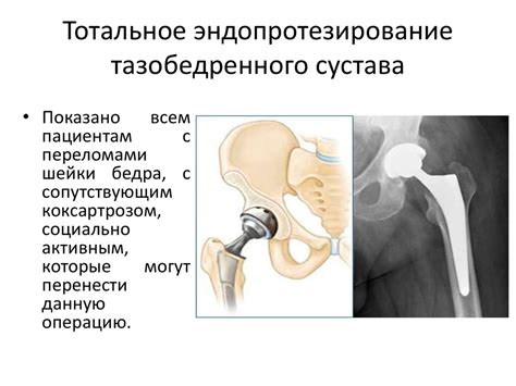 Эндопротезирование тазобедренного коленного суставов презентация онлайн