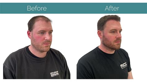 Exploring The Rise Of Beard To Scalp Hair Transplants Ik Clinics