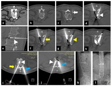 Percutaneous Ct Guided Microwave Ablation Combined With Pedicle Screw Fixation Followed By