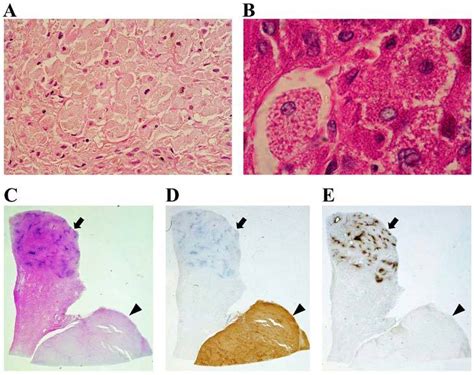 Granular Cell Tumor Larynx