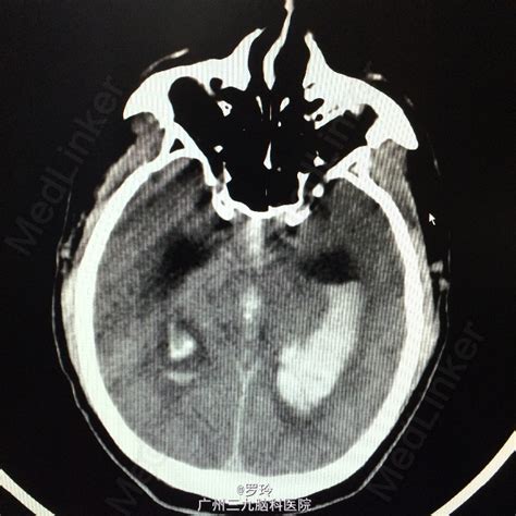 I医联 基底节区出血破入脑室后死亡