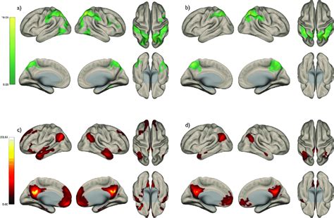 Dorsal Attention Network In A Healthy Controls And B Pca Patients Download Scientific