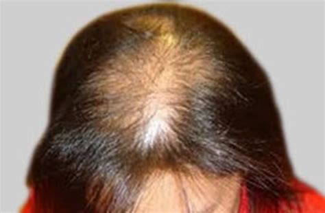 Diffuse Unpatterned Alopecia Causes Symptoms Treatment